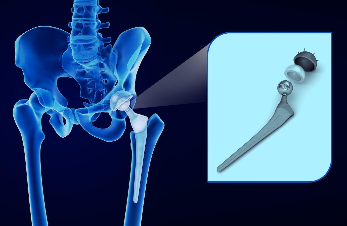 La protesi è personalizzata e stampata in 3D